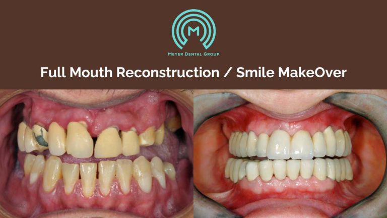 Full Mouth Reconstruction - Smile Makeover, Mount Prospect